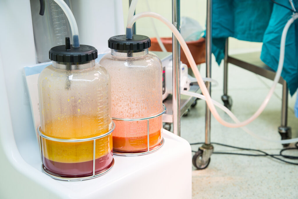 Awake Lipo - Great Liposuction Results NO General Anesthesia